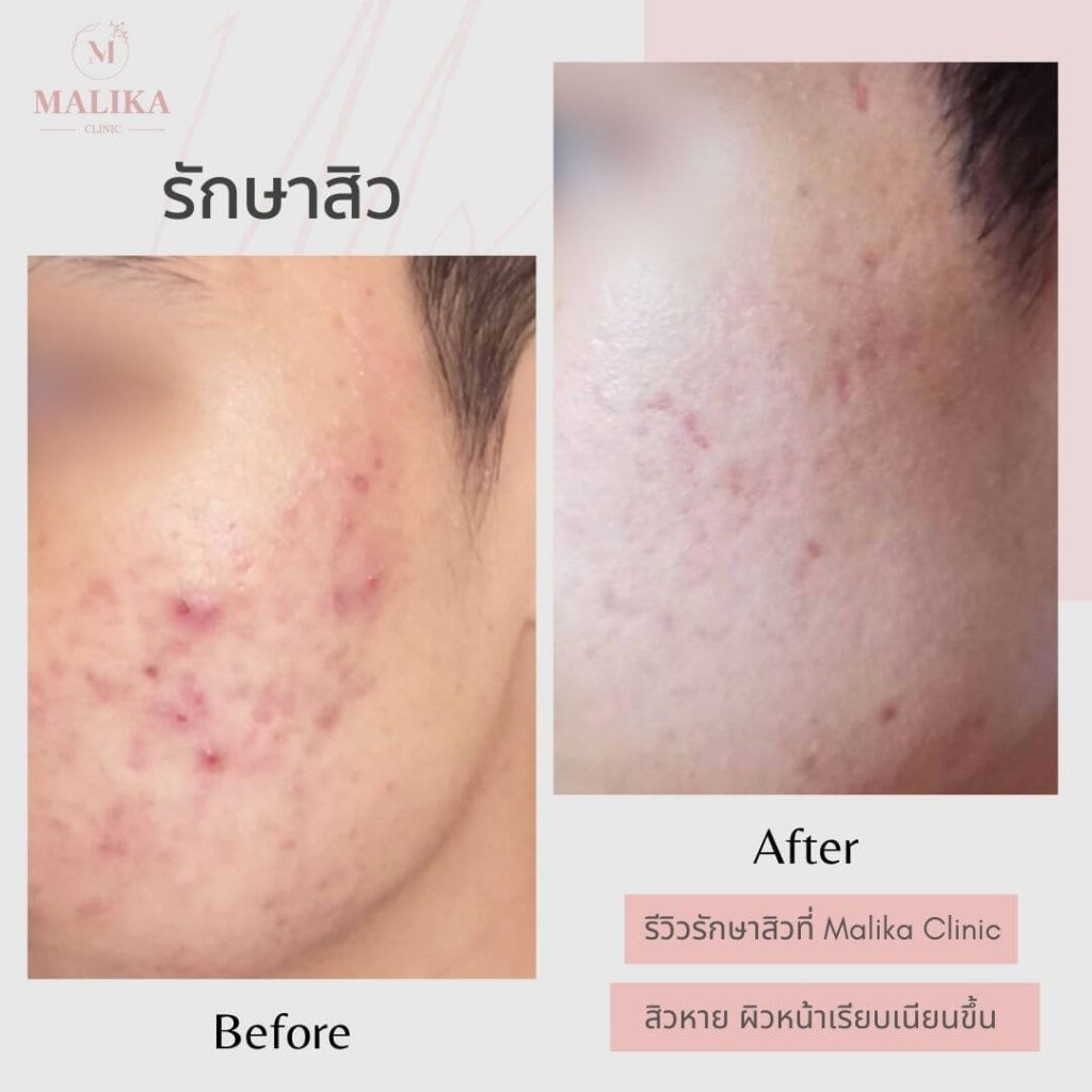 Promotion Acne - Malika Clinic by Dr. Ben
